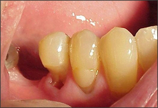 Abrasion and Recession - Using an Evidence-based Approach to Making ...