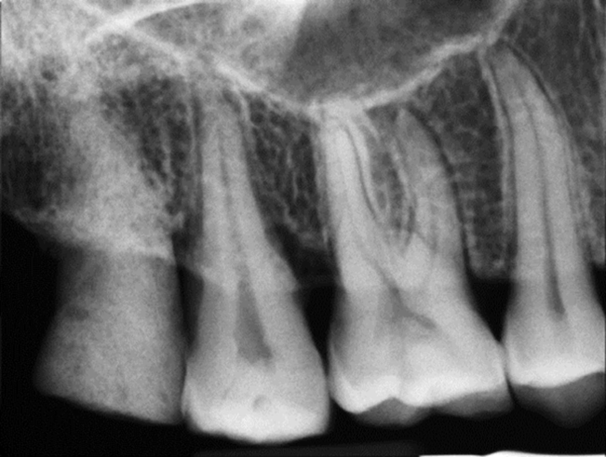Normal Radiographic Appearance of the Supporting Structures of the ...