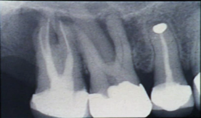 Diagnostic Information | Enlarging Radiolucency of the Right Posterior ...