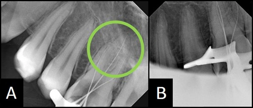 Problem #10: Capturing the Apex during an Endodontic Procedure ...