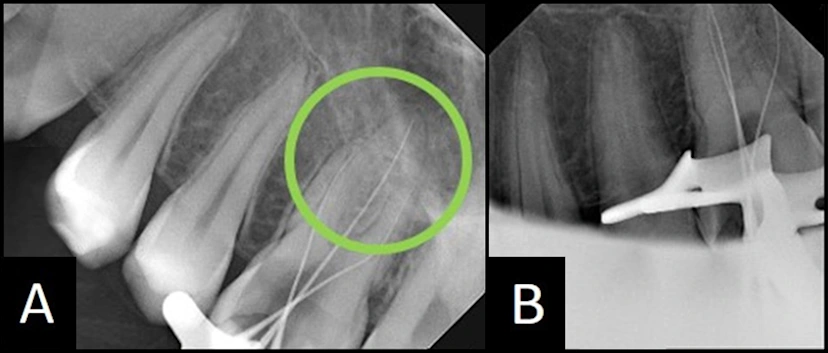 Problem #10: Capturing the Apex during an Endodontic Procedure ...
