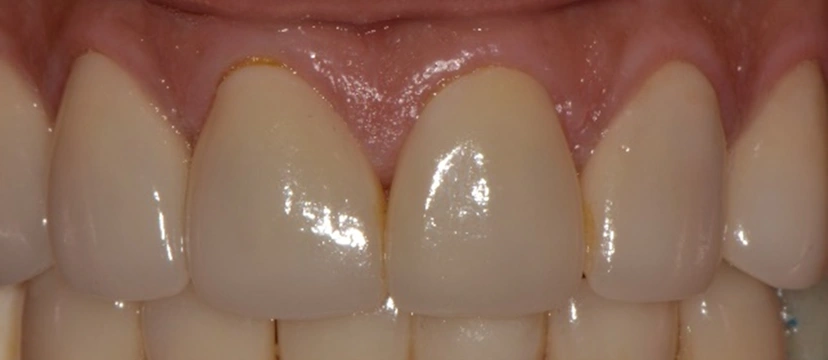 Assessment of the Form of Adjacent Teeth | Biologically Contoured ...