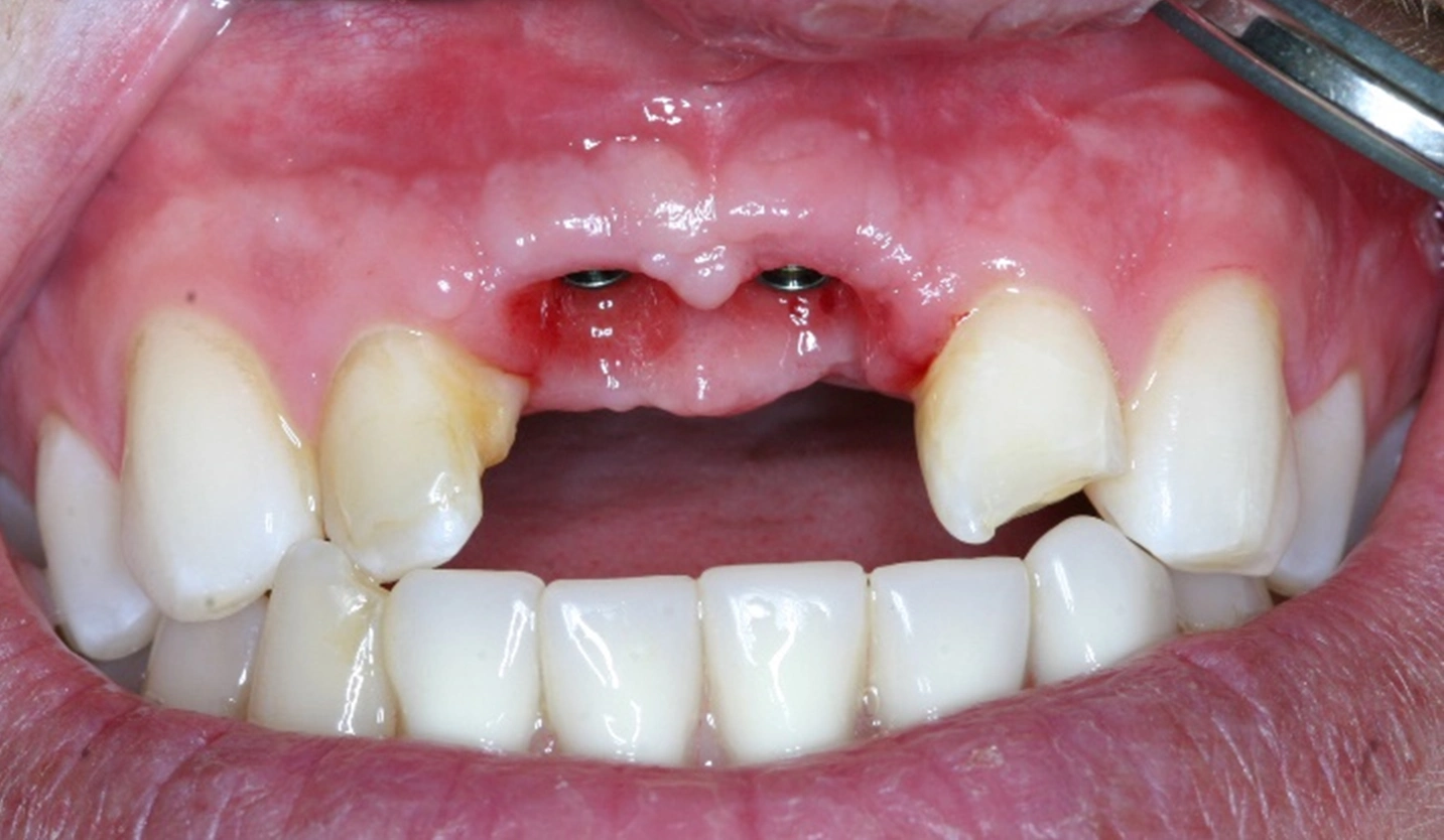 Placement of a Well-contoured Provisional Restoration/Custom Healing ...