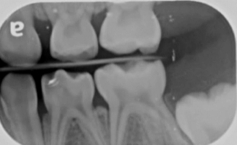 Bitewing Radiographs - Radiographic Techniques for the Pediatric Patient - Dentalcare