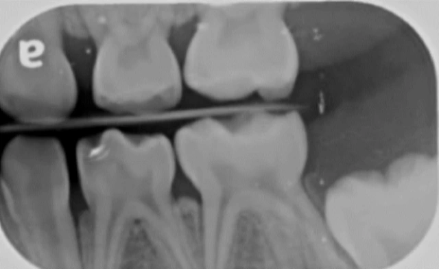 Bitewing Radiographs - Radiographic Techniques for the Pediatric ...