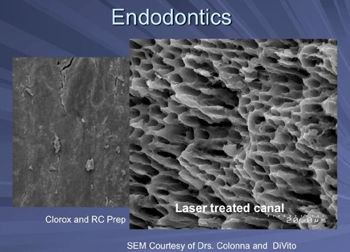 Endodontic Applications | Lasers in Dentistry: Minimally Invasive ...
