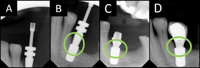 Problem #7: Images for Implant Procedures | Intraoral Imaging ...
