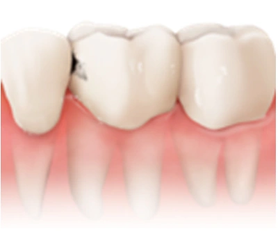 Carious Lesions - Professional Dental Terminology for the Dental ...