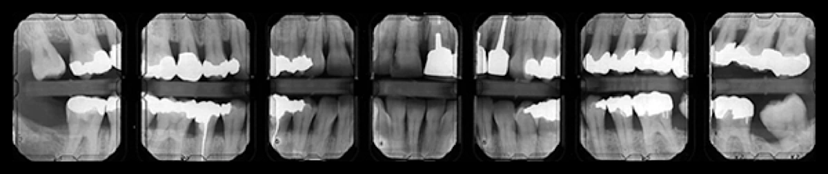 Intraoral Radiographic Techniques - Intraoral Imaging: Basic Principles ...