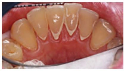 Dental Calculus Treatment - Stannous Fluoride Toothpaste | Dentalcare