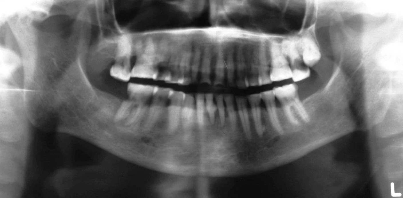 Attrition - Anomalies of Tooth Structure - Dentalcare