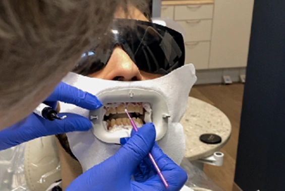 In Office Treatment | How Whitening Works | Continuing Education Course ...