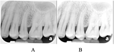 Radiographic Density - The Radiographic Image - Dentalcare