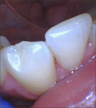 Clinical Signs of Bruxism - Bruxism: The Grind of the Matter - Dentalcare