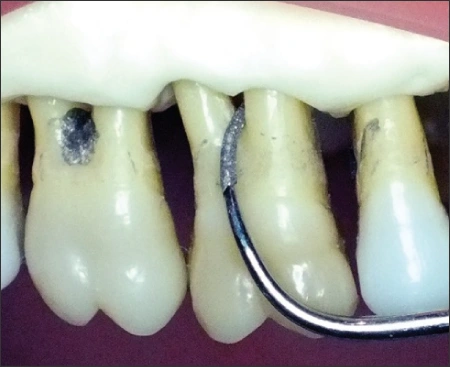 Diamond Coated File Scalers - Advanced Instrumentation for the General ...