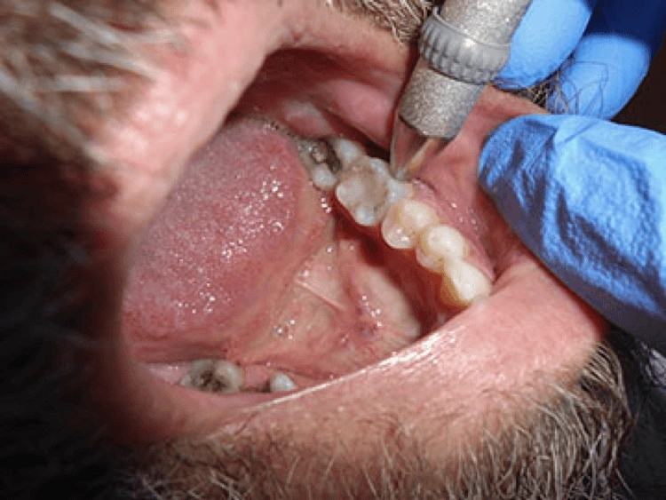 Percussion Tests for Determining the Status of the Periodontal Ligament ...