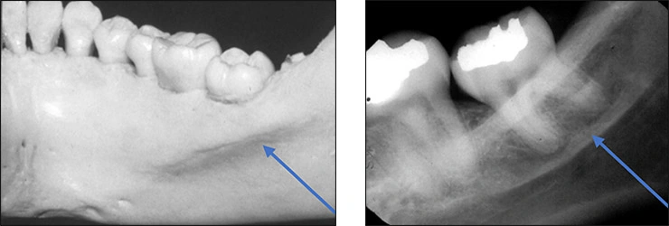Mandibular Posterior Landmarks - Intraoral Radiographic Anatomy ...