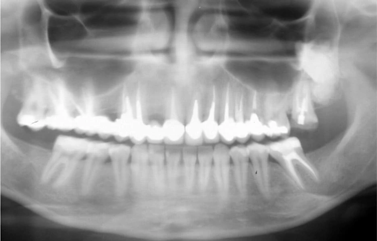 Case #4 Diagnoses: Complex Odontoma - Radiographic Interpretations ...