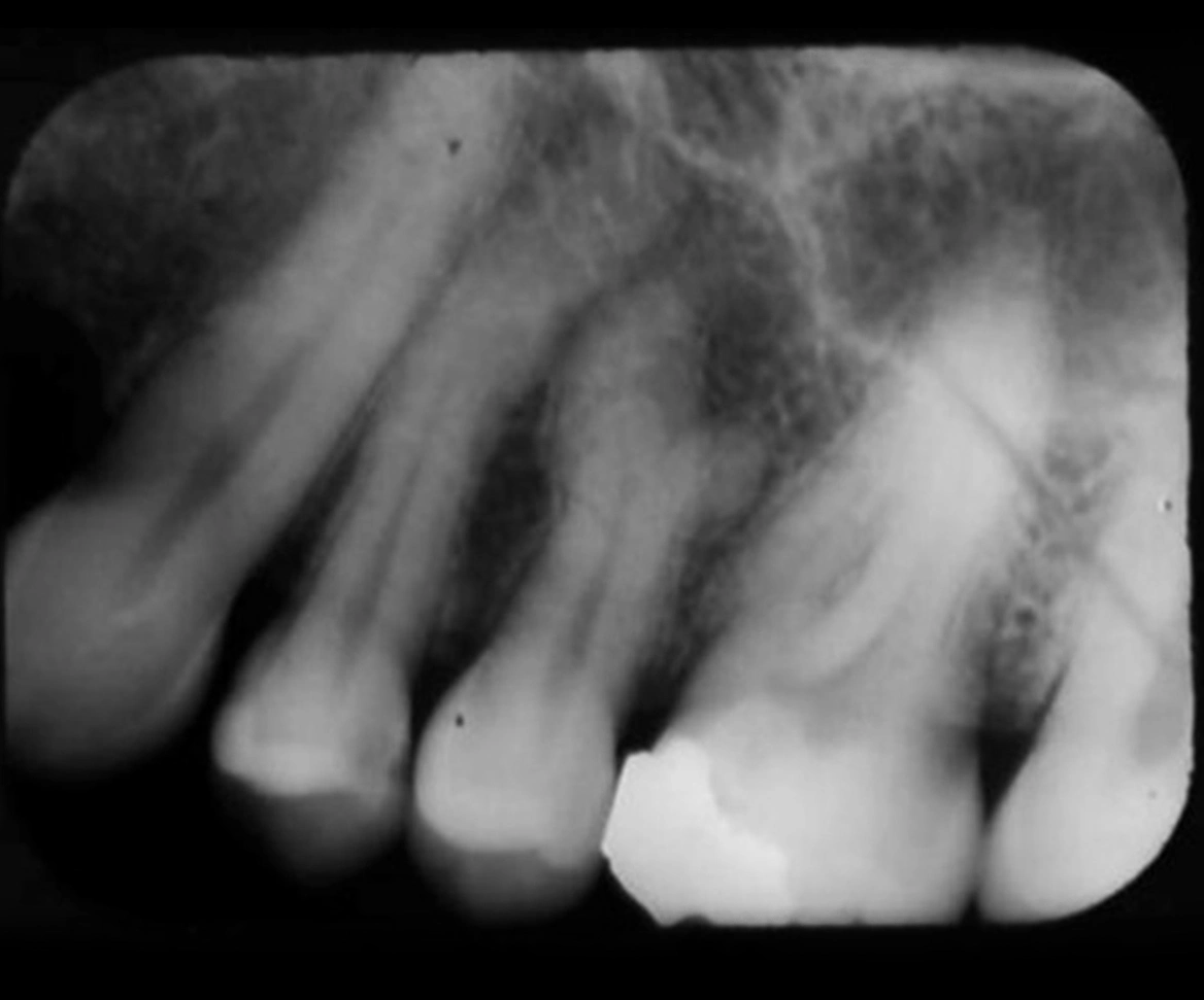 Dilaceration - Anomalies of the Tooth - CE651