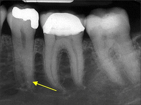 Supernumerary Roots - Anomalies of Tooth Structure - Dentalcare