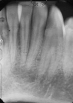 Supernumerary Roots - Anomalies of Tooth Structure - Dentalcare