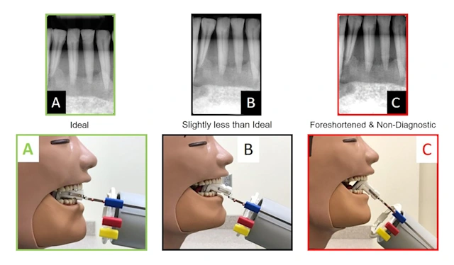 Vertical Angulation: Why are the mandibular anterior teeth always ...