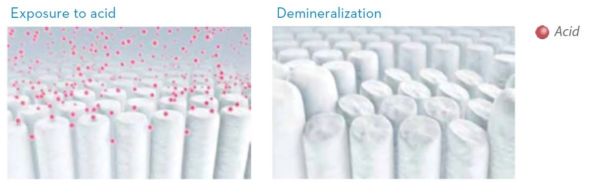 Erosion & Hypersensitivity Treatment - Stannous Fluoride Toothpaste ...