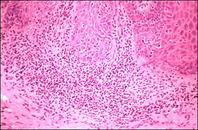 Diagnostic Information | White Plaque of the Lateral Tongue ...