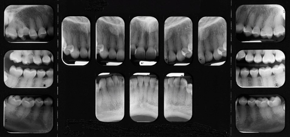 Loss of Tooth Structure - Anomalies of Tooth Structure - Dentalcare