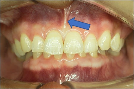 Terms D-L - Oral Health Care: A Whole New Language - Dentalcare