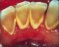 Tartar Control - Choosing a Toothpaste: What’s the Big Deal? - Dentalcare