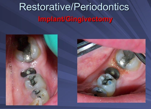 Gingivectomy | Lasers in Dentistry: Minimally Invasive Instruments for ...