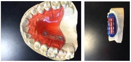 Lesion Progression Methods - Managing Dental Erosion: Current ...