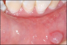 Reactive Soft Tissue Enlargements | A Guide to Clinical Differential ...