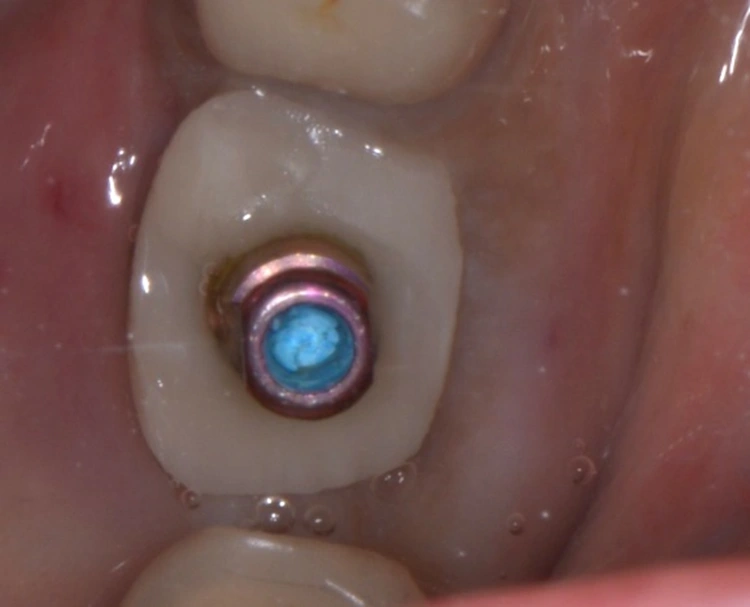 Placement of a Well-contoured Provisional Restoration/Custom Healing ...