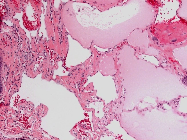 Diagnostic Information | Asymptomatic Bumps Left Posterior Tongue ...