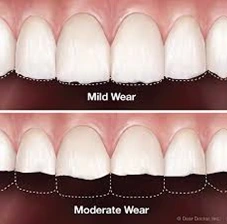 What is Dental Erosion? How to Stop Tooth Erosion | Dentalcare