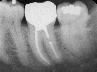 Enamel Pearls - Anomalies of Tooth Structure - Dentalcare