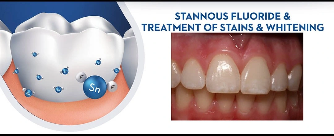 Anti-Stain and Whitening - Stannous Fluoride Toothpaste | Dentalcare