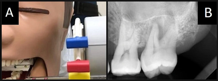 Vertical Angulation Why Are The Incisal Edges Cusp Tips Not Captured ...