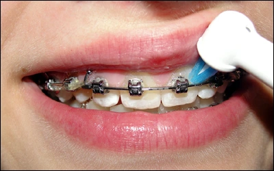 Power Toothbrushes - Ortho 101 for the Dental Professional - Dentalcare