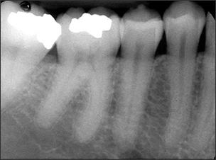 Normal Radiographic Appearance of the Supporting Structures of the ...