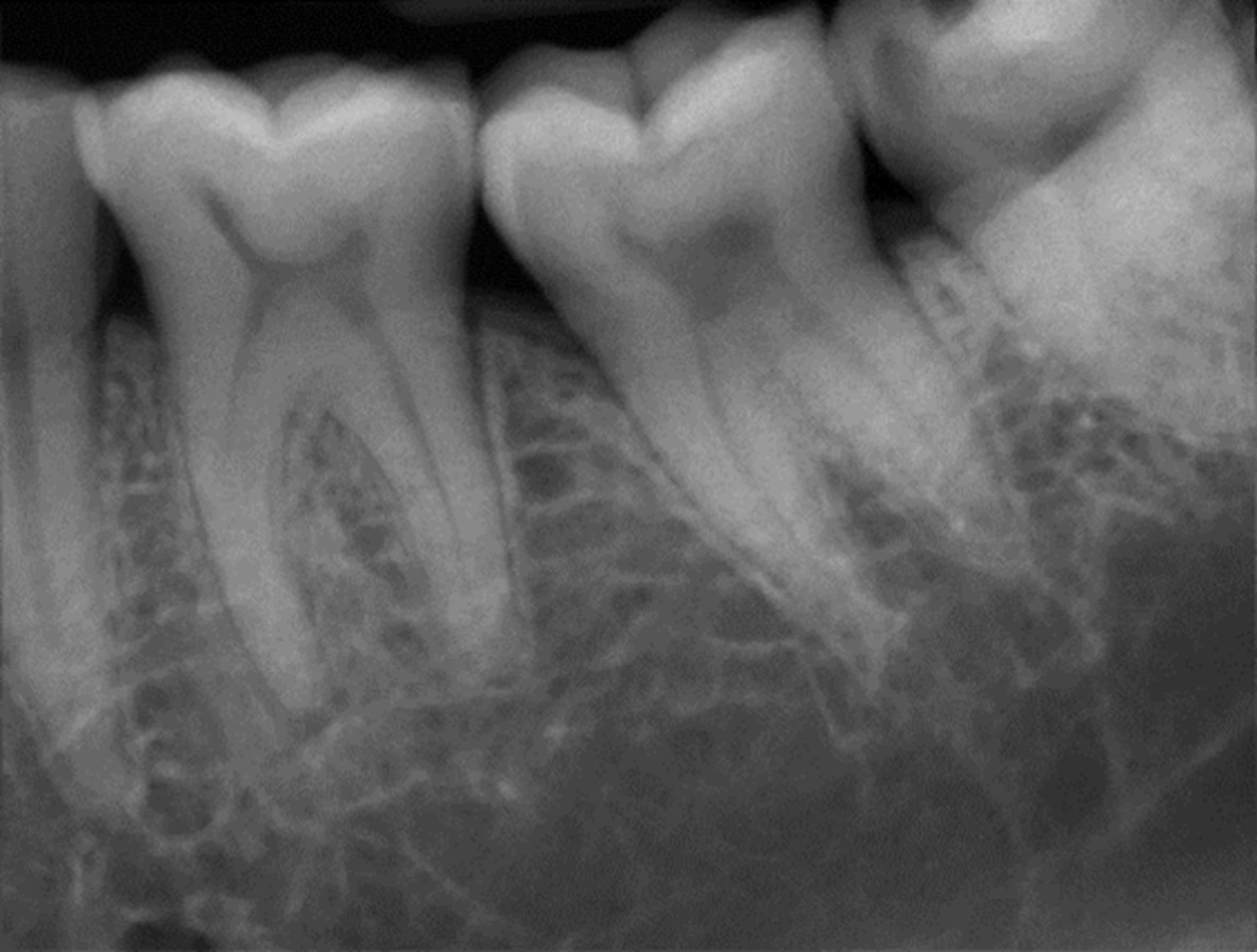 Normal Radiographic Appearance of the Supporting Structures of the ...