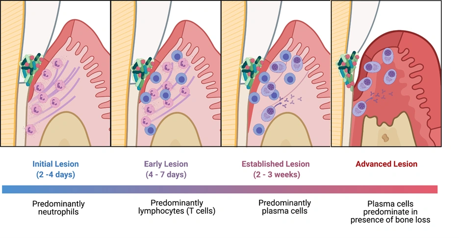 Established Lesion (2-3 weeks) | Immunological and Inflammatory Aspects ...