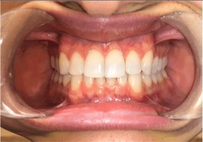 Terms D-L - Oral Health Care: A Whole New Language - Dentalcare