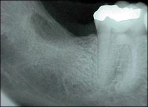 Diagnostic Information | The Case of the Post-Extraction Bone Lesion ...