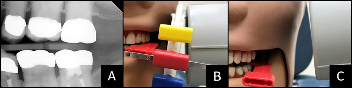 Problem #4: Bitewing Images Not Ideal | Intraoral Imaging Techniques ...