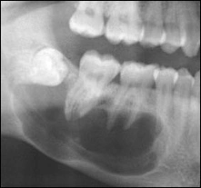 Diagnostic Information | The Case of a Subtle Expansion of the Mandible ...