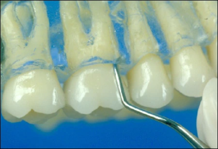 Langer Curettes - Advanced Instrumentation for the General Practice ...