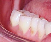 Diagnosis | Dentinal Hypersensitivity: A Review | Continuing Education ...